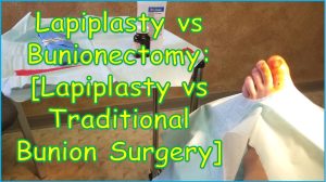Lapiplasty vs Bunionectomy: Which One Is Better?