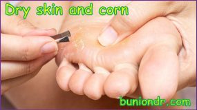 What Is The Difference Between A Corn and A Bunion?