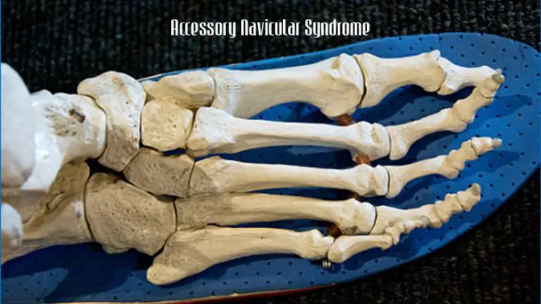 Best Shoes For Accessory Navicular Syndrome: Comfort Meets Relief ...